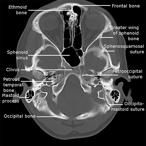 Greater Wing Of Sphenoid Radiograph